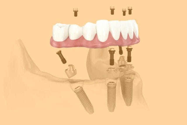 Implante Prótese Fixa Protocolo Como Funciona? - Oral Unic Tatuapé